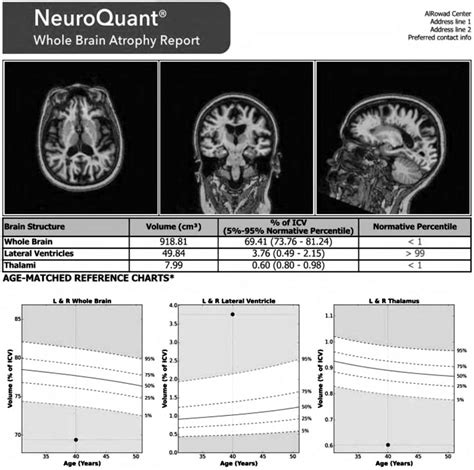 Fully Automated Segmentations Performed By Neuroquant®2 0 Shows Whole Download Scientific