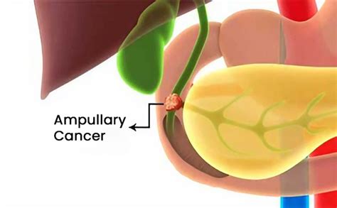 Breaking Down Ampullary Cancer Causes Risks And Survival Rate