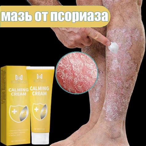Mrandmiss Антипсориаз Крем мазь негормональный от псориаза экземы нейродермита грибковых