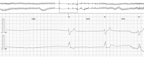 What Is A Ventricular Escape Beat