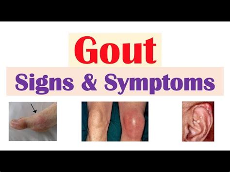 Gout Signs And Symptoms Why They Occur