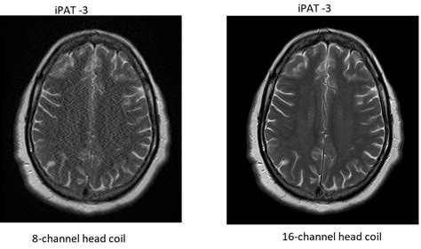 Parallel Imaging Artifact Mri Parallel Imaging Artifact
