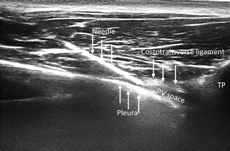 Comparison Of The Results Of Ultrasound Guided Thoracic Paravertebral Block And Modified