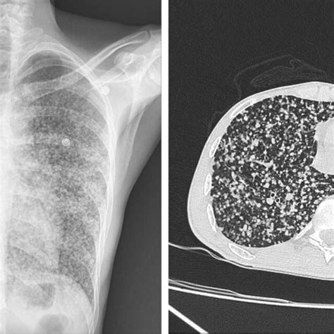 Patients Lung Computed Tomography Download Scientific Diagram