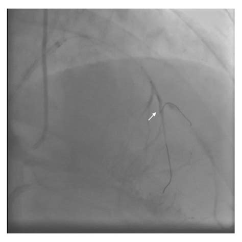 A A Patient With Cto At The Proximal Anterior Descending Branch