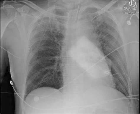 Cxr On Presentation Revealing A Widened Mediastinum Download Scientific Diagram