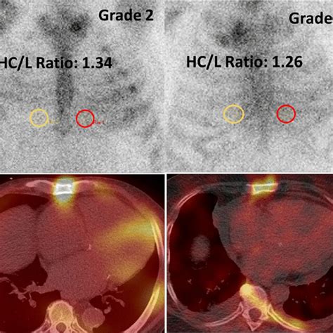 Typical Echocardiographic Features Of Cardiac Amyloid Involvement Download Scientific Diagram