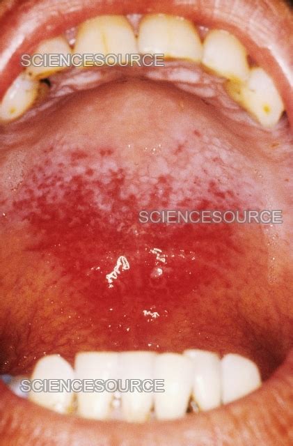 Nicotine Stomatitis Tongue