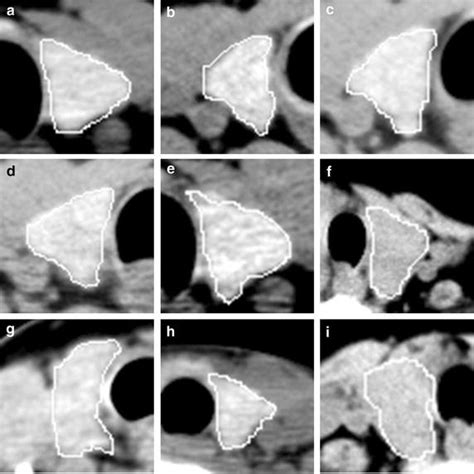 The Procedure Of Roi Extraction In Thyroid Ct Image A The Contour Of A
