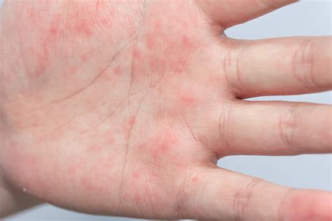 汗疱疹和湿疹的图片疹子第10页大山谷图库
