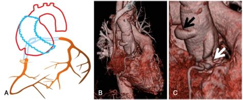 Schematic Illustration Of The Cabrol Procedure Showed That After Download Scientific Diagram