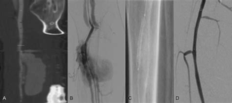 A Computed Tomography Angiogram Shows A Large Irregular Aneurysm Download Scientific Diagram