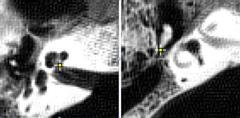Landmarks In Addition To The Cochlear Round Window Needed To Define Download Scientific