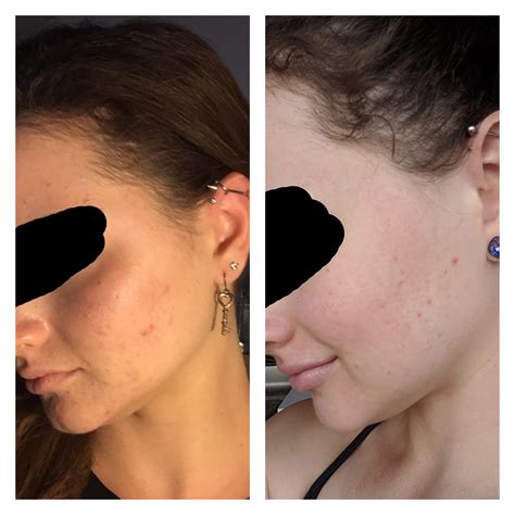 Left Before Accutane Full Coverage Makeup Right 3 Weeks Post