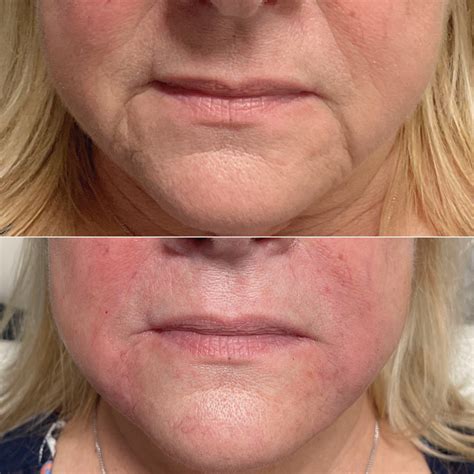 Sculptra Willis Cosmetic Surgery Skin Rejuvenation St Louis