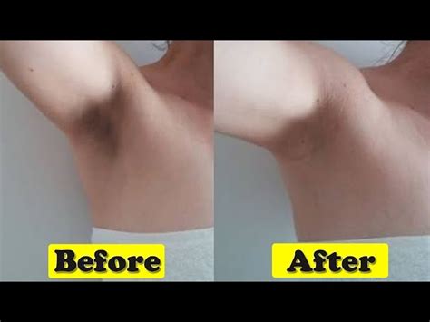 How To Get Rid Of Dark Underarms Overnight Dark Underarms Home Remedy