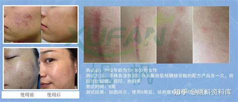 多聚脱氧核糖核苷酸【dna钠】 知乎