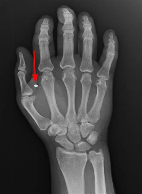 Foreign Body Imaging With Mri Radsource