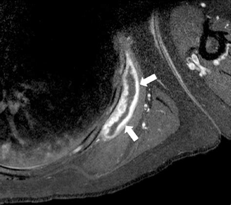 Scapulothoracic Bursitis And Snapping Scapula Imaging Perspectives Semantic Scholar