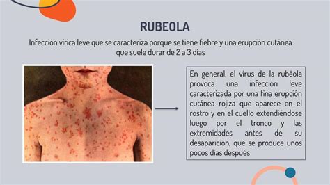 Rubeola Vs Erupcao Cutanea De Rubeola