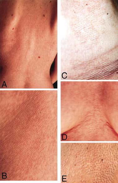 Mid Dermal Elastolysis A Clinical Histologic And Immunohistochemical