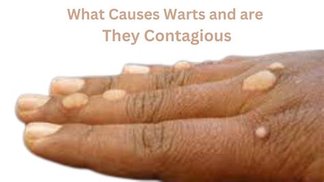 Can Warts Spread Through Towels At Kristin Morton Blog