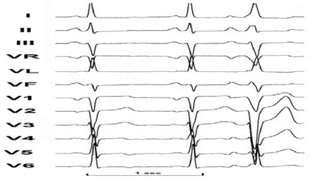 12 Lead Ecg Showing The Atrial Premature Beat With Pt Phenomenon With