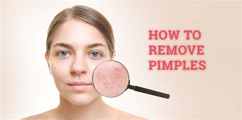 Tips By Physicians On How To Remove Pimples And Pimple Marks