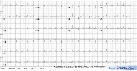Cardiac Tamponade