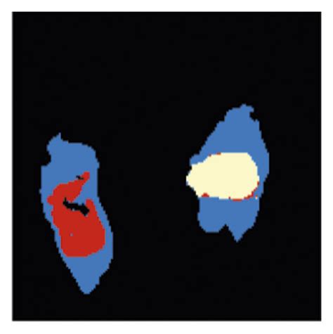case 2 tumor spread and metastasis can reflect segmentation effects on