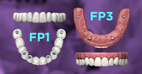 Fp1 Dental Treatment What It Is And Why It Matters
