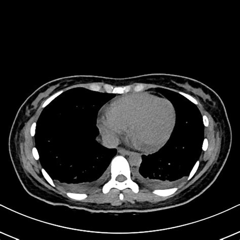 Choledocholithiasis And Choledochal Cyst Radiopaedia 79452 92568 Axial
