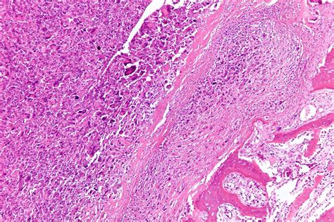 50 Facts About Osteosarcoma
