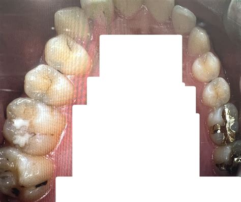엑스레이 및 구강사진으로 충치진단 ㅣ 궁금할 땐 아하