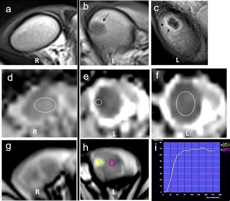 Multiparametric Mri A C T2 Weighted Sequence Axial T2 Weighted Download Scientific Diagram