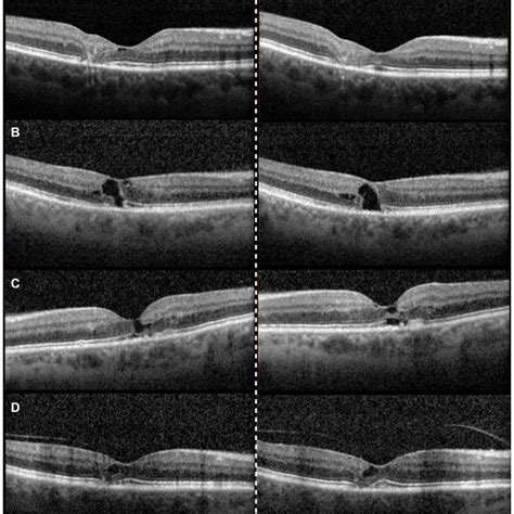 Representative Examples Of Ellipsoid Zone Ez Loss On Spectral Domain