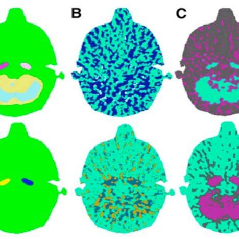 PDF A Survey Of PET Image Segmentation Applications In Oncology Cardiology And Neurology