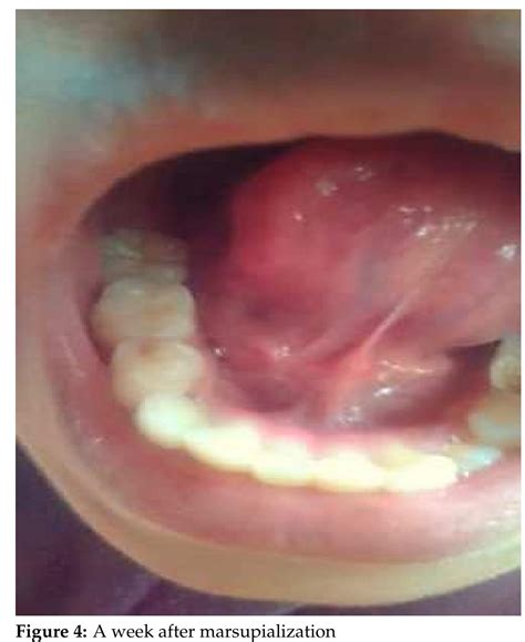 Figure 4 Marsupialization As A Ranula Management Case