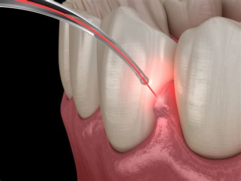 Coding For Laser In Dentistry Practice Booster