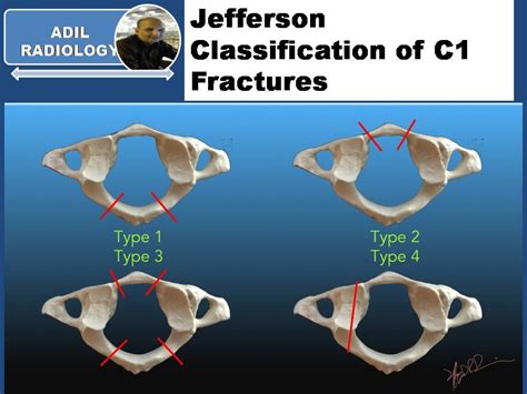 Jefferson Classification Of C1 Radiology Classroom Facebook