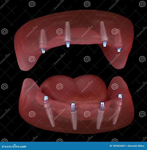 Maxillary And Mandibular Prosthesis With Gum All On 4 System Supported By Implants Medically
