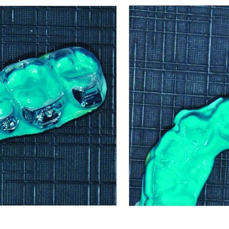 Pdf Effectiveness Of A Selective Etching Technique In Reducing White