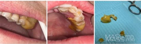 Сэрэмжлүүлэг Хиймэл яс гэдэг зүйл хэрэглэж эрүүл мэндээрээ хохирчээ