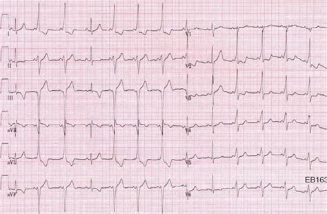 Left Axis Deviation ECG Book