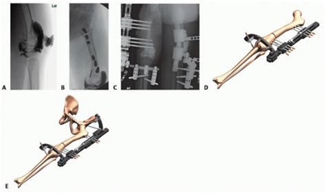 Treatment Of Congenital Femoral Deficiency Musculoskeletal Key