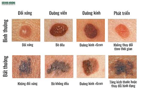 Nốt ruồi có những biểu hiện này cần nghĩ ngay đến ung thư TRUNG TÂM Y TẾ QUẬN 5