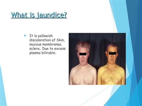 Bilirubin Meabolism And Jaundice And Liver Failure Ppt
