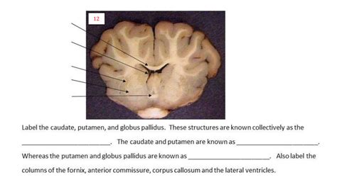Solved Label The Caudate Putamen And Globus Pallidus