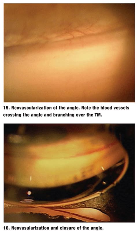 The Open And Closed Case For Gonioscopy