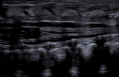 Caudal Regression Syndrome Ultrasound